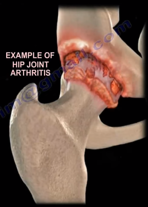 Rectus Femoris Strain Advancing Recovery By Incorporating