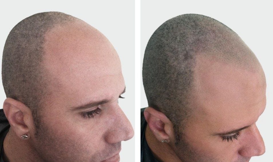 London’s Premier Scalp Micro Pigmentation Provider | Medium