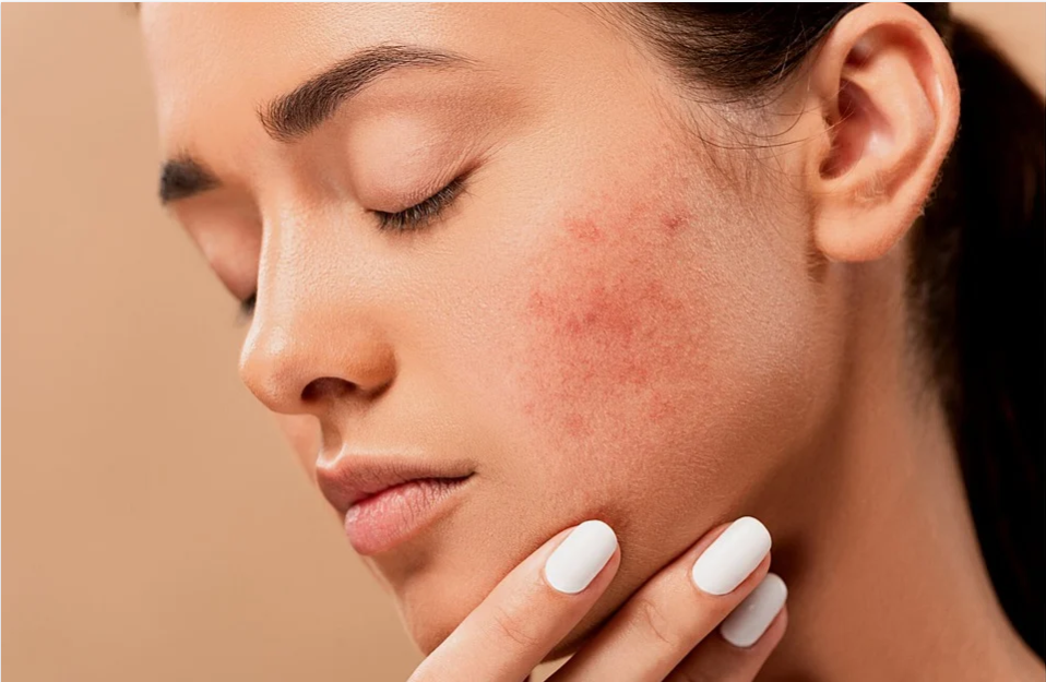 How To Get Rid Of Acne 3 Steps Toward A Fair Complextion - Paloolu ...