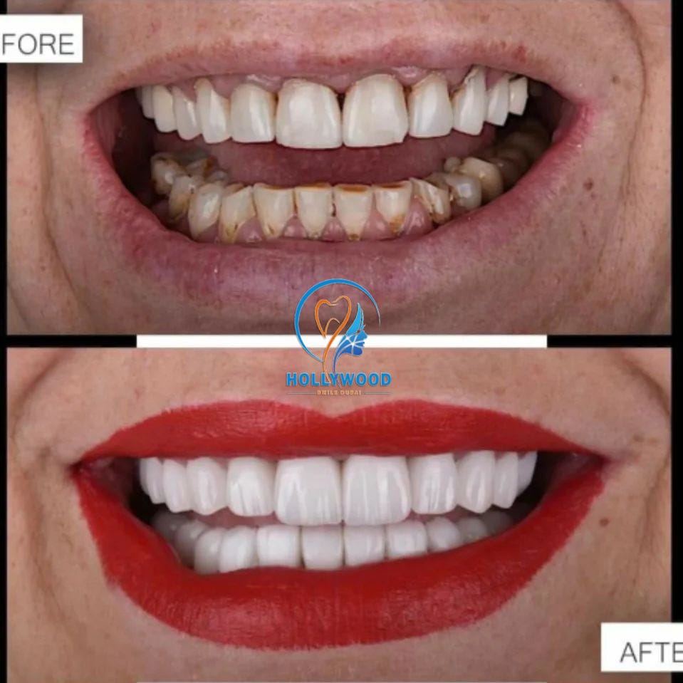 Hollywood Smile - Hollywood Smile - Medium
