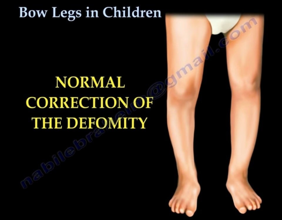 Bow Legs in Children. Nabil Ebraheim, M.D. | by Nabil Ebraheim | Medium