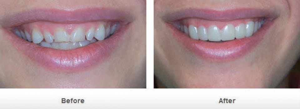 Snap-On Teeth. Snap-ons are removable row of teeth… | by Fort York ...