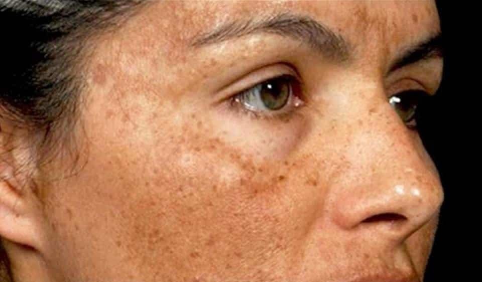 Overviewing the Advances in Pigmentation Disorder Treatment | by ...