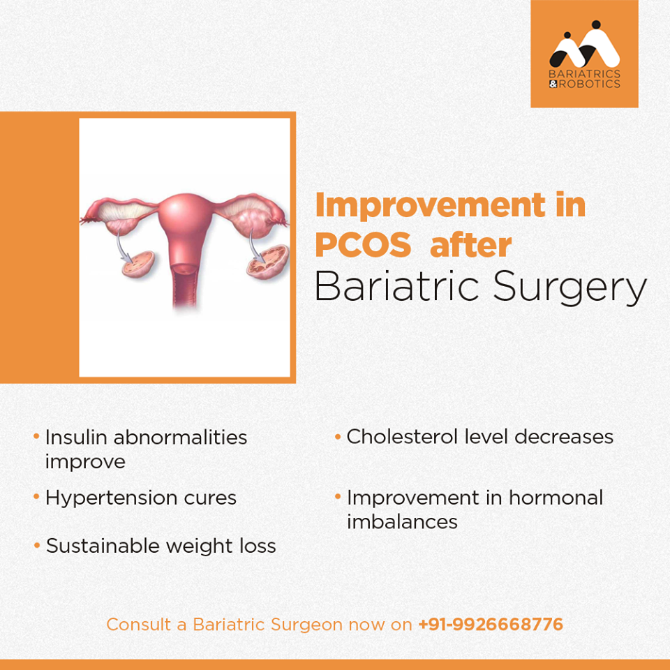 Improvement in PCOS after Bariatric Surgery | by Dr. Mohit Bhandari ...