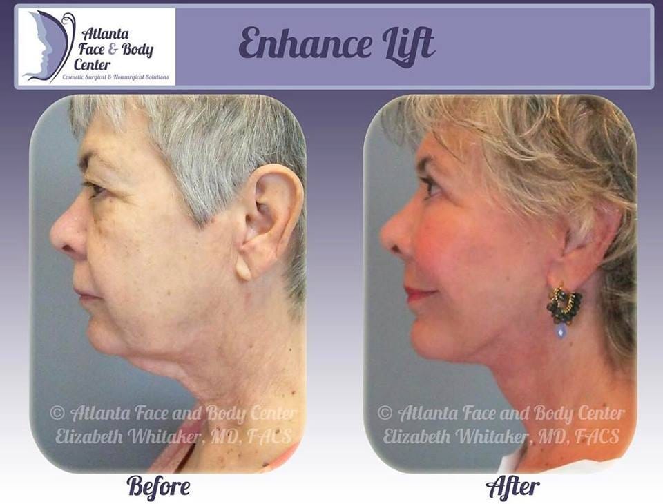 Atlanta Plastic Surgeon. Atlanta Face & Body | by Dr. Elizabeth ...