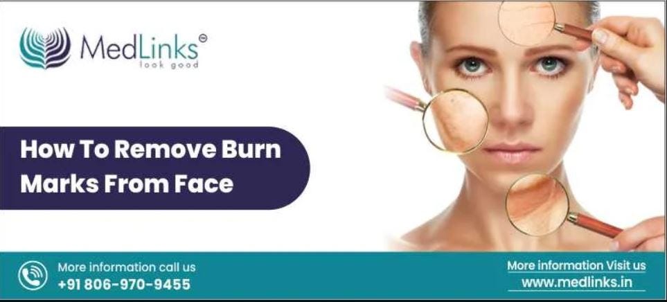 How to Remove Burn Marks from Your Face: Tips for Clearer Skin | by ...