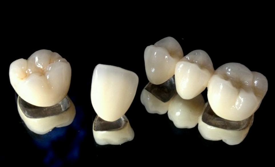 Shining Brilliance: The Metal Ceramic Crown | by Dentcaredental | Jul ...
