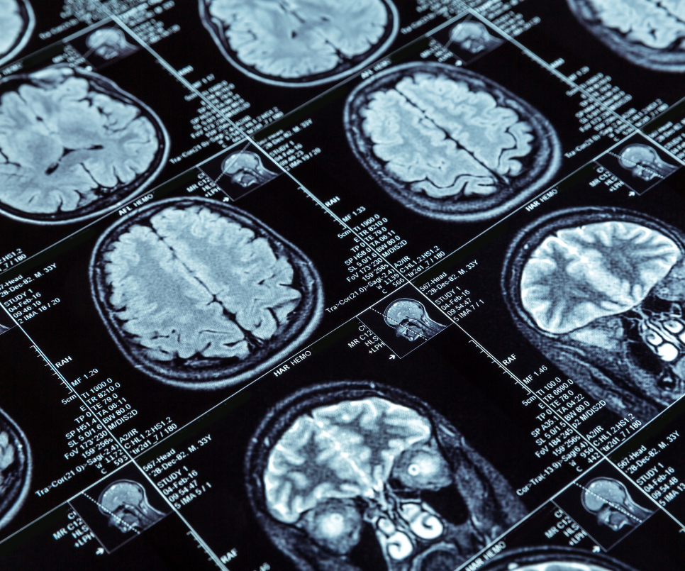 Advancing Brain MRI Image Classification with Deep Learning | by Jason ...