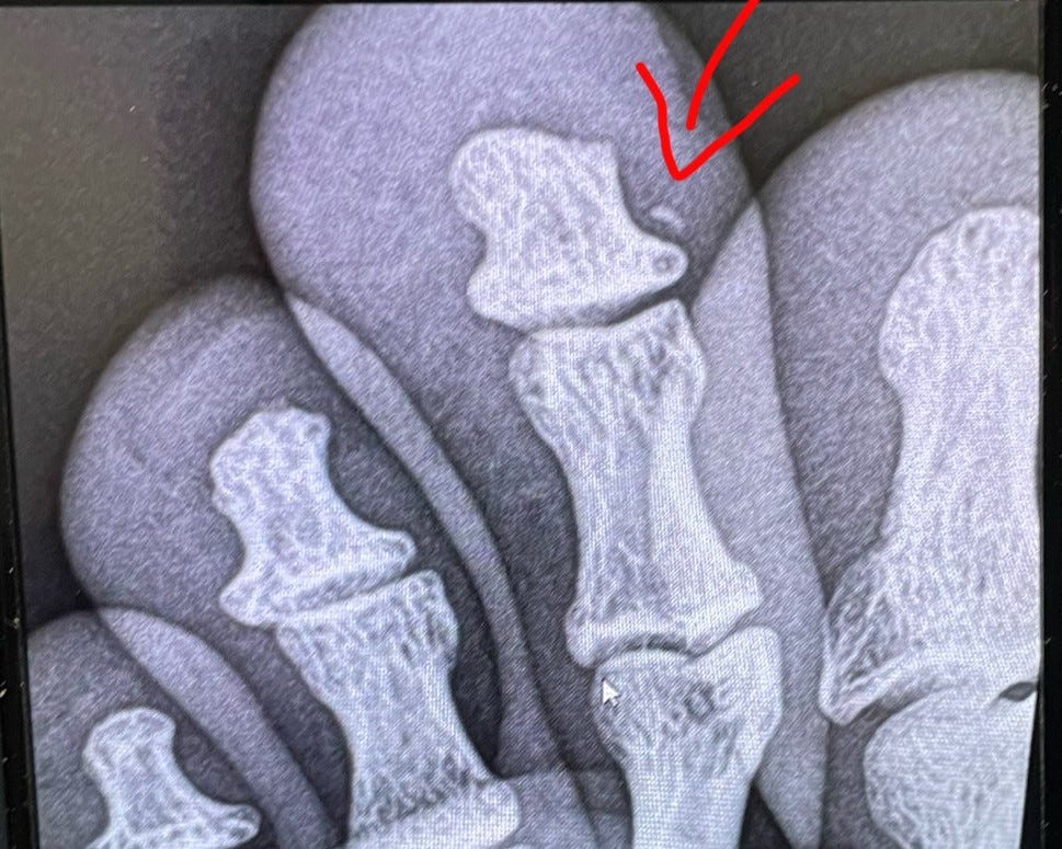 I Fractured My Toe. How I Respond Matters Much More | by Karthik ...