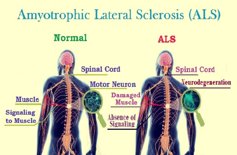 What Is ALS Experts Explain Symptoms To Look Out For Causes And What Is ALS Experts Explain Symptoms To Look Out For Causes And