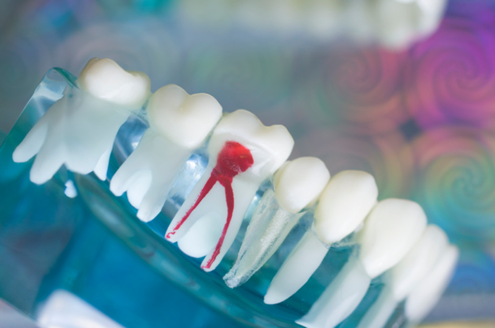 How To Treat Pain After a Root Canal | by Shermanmtravis | Medium