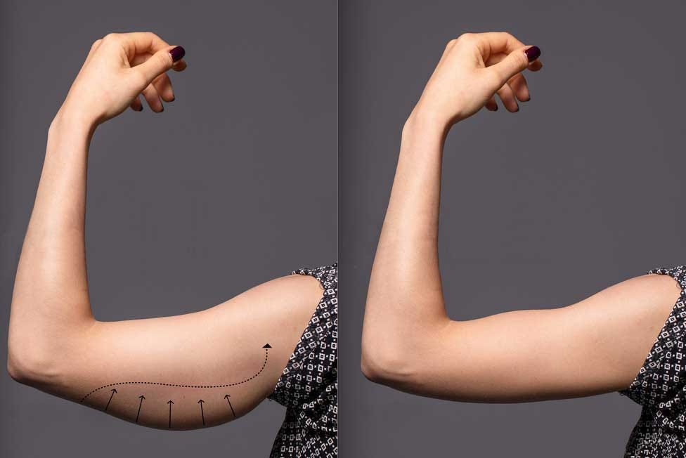 Arm Lift-Asthetic Procedure. Restorative surgery and plastic surgery ...