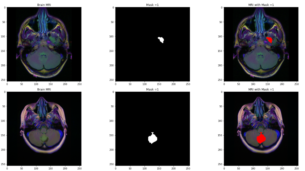Brain tumor segmentation with deep neural networks | by Aditya Bodhankar | Medium