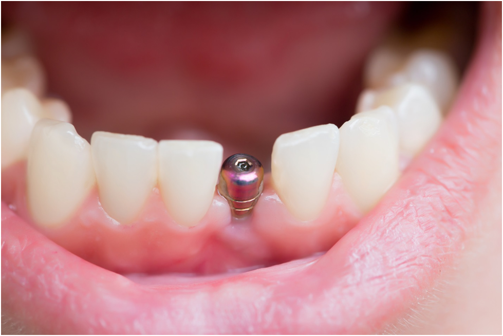 What is a dental implant?. A dental implant is a small titanium… | by ...