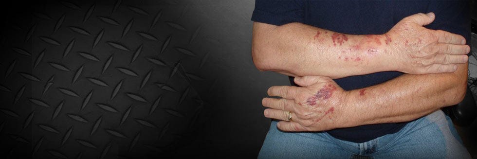 5 Times You Should Wear Arm Protectors | by Rick Redman | Medium
