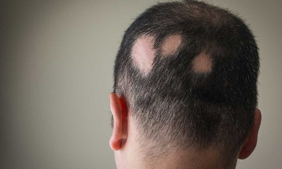 Alopecia Areata: From Autoimmune Roots to Scalp Realities | by Hair ...