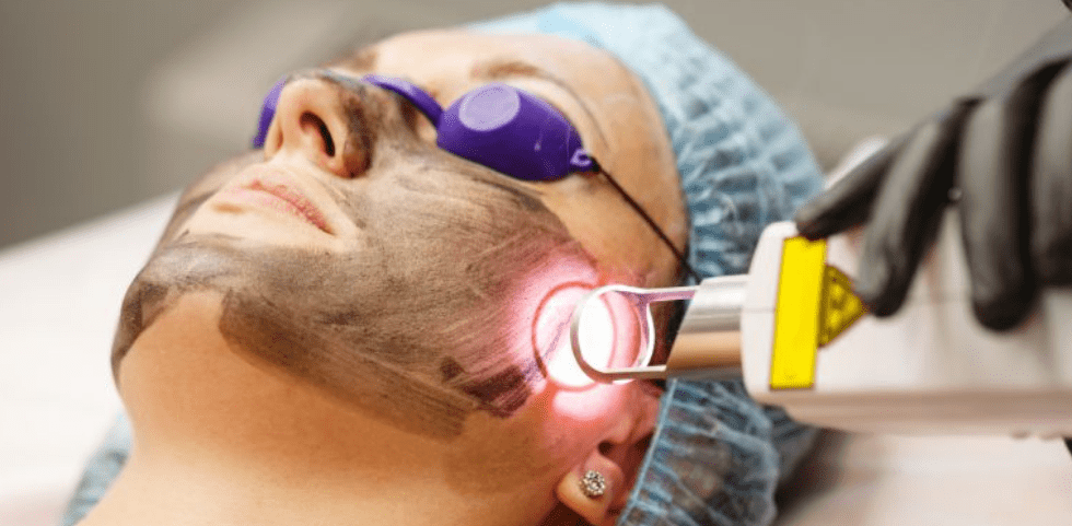 Unveiling the Wonders of Charcoal Q Switch Treatment | by ...