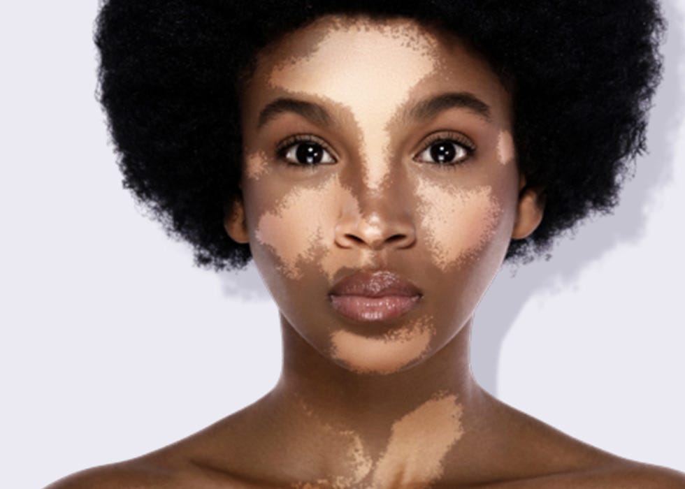 Myths and Facts About Vitiligo. Vitiligo is a skin condition that has ...