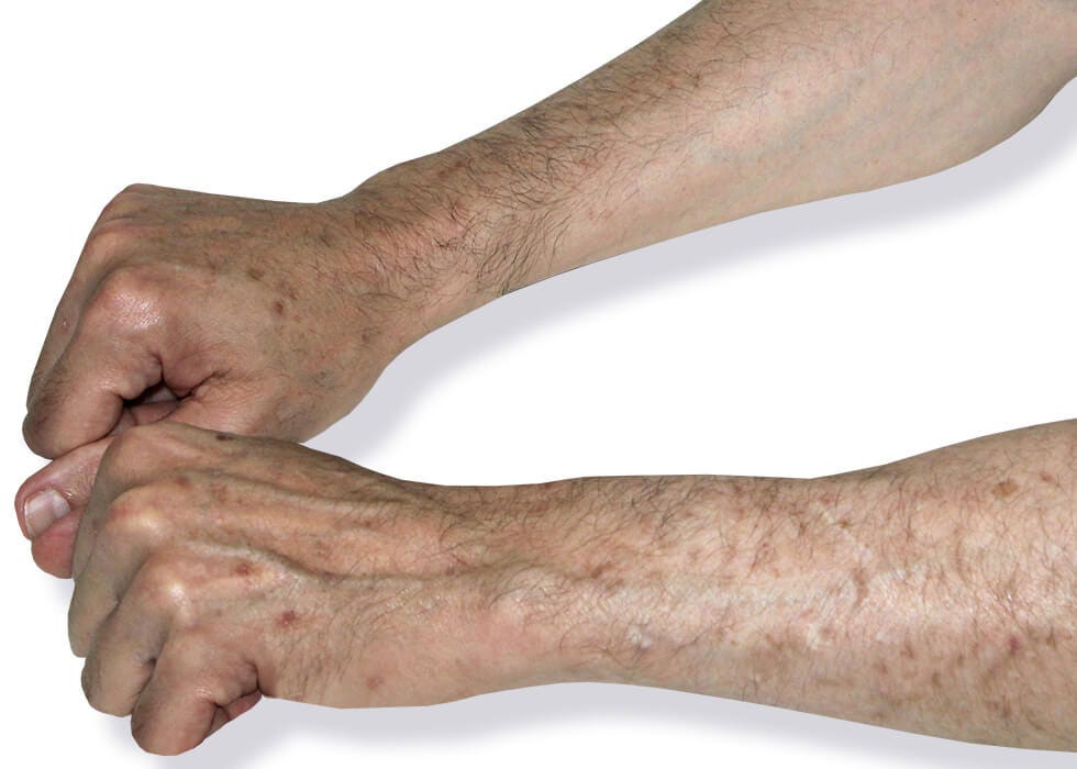 “Unveiling Radiant Skin: Actinic Keratosis Treatment Choices in Dubai ...