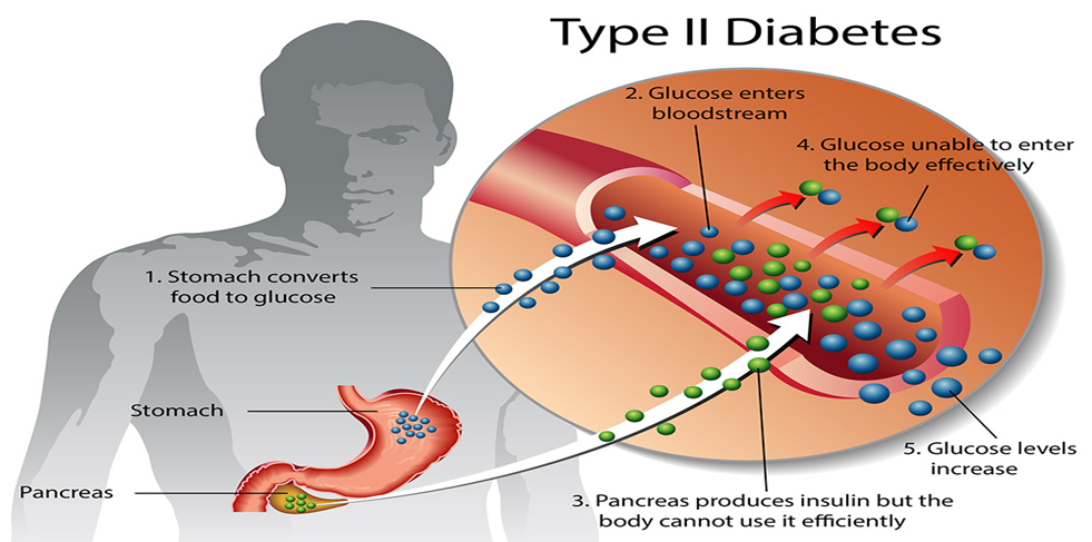 How To Control and Reverse Type 2 Diabetes Without Medication | by ...