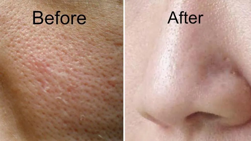 Small Pores On Face