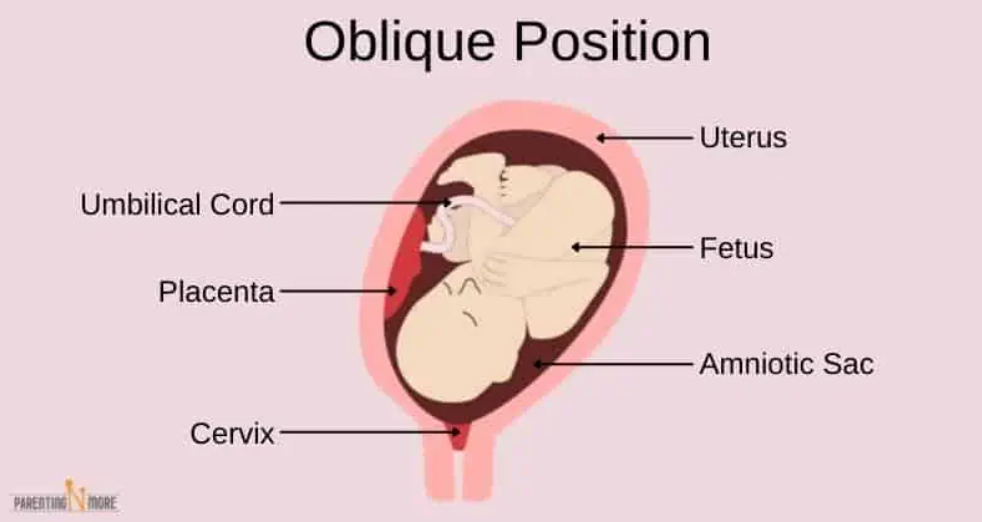 Oblique Position in Pregnancy: Causes, Risks, and Delivery ...