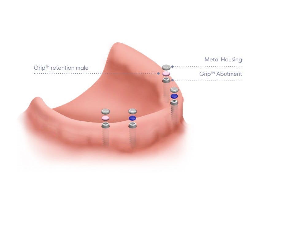 The Grip™ Attachments Advantage | Adin Dental Implant Systems India ...
