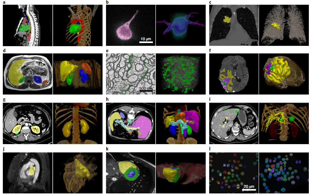 Brief Review — Nnu Net A Self Configuring Method For Deep Learning Based Biomedical Image