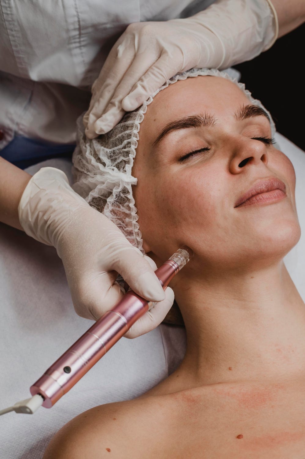 Micro-needling in Queens - True Laser Spa New York - Medium