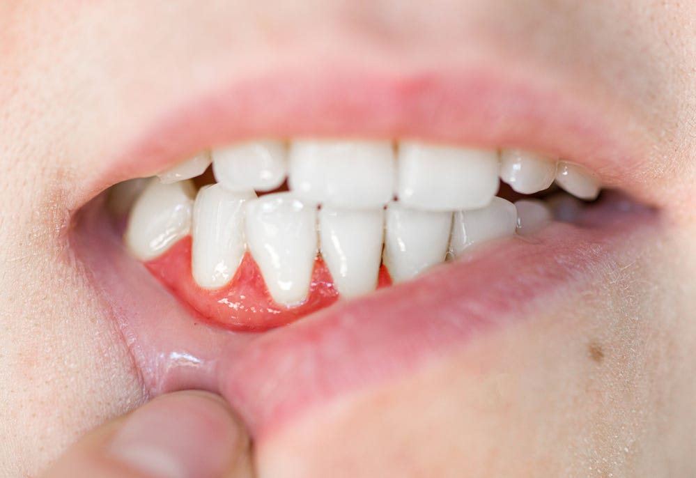 Top 10 Bleeding Treatments in Dubai & Abu Dhabi | by Dental Aesthetic ...